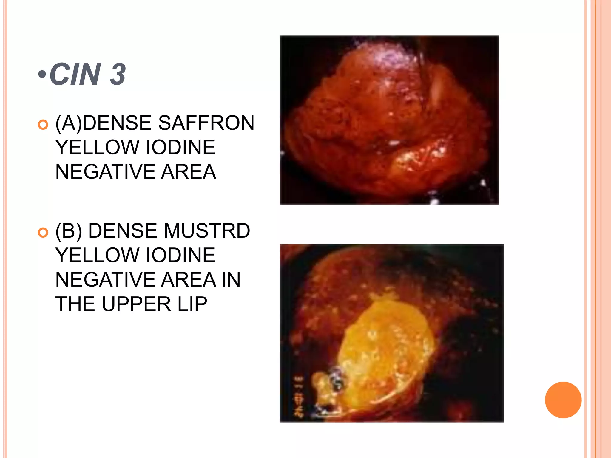 Colposcopy examination | PPTX