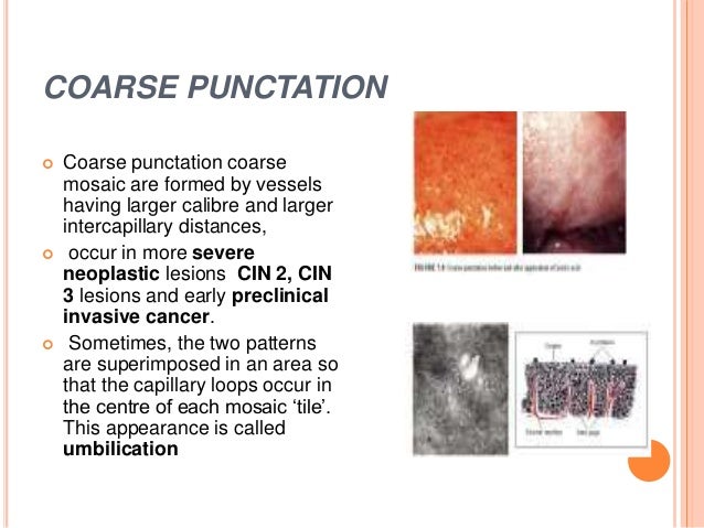 Colposcopy examination