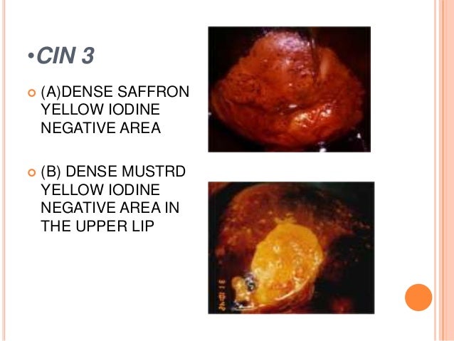 Colposcopy examination