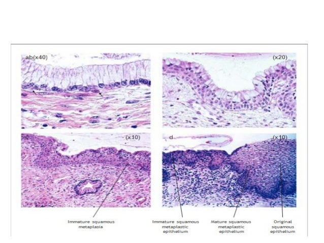 Cervix Transformation Zone Histology