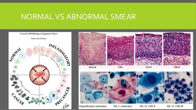 Colposcopy attendance in women with High Grade Lesion of Cervix and h…