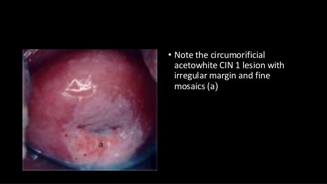 Colposcopy technique