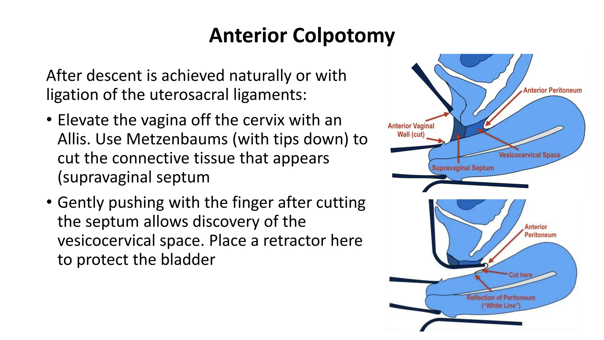 Vaginal Hysterectomy Anterior and Posterior Colpotomies | PPTX