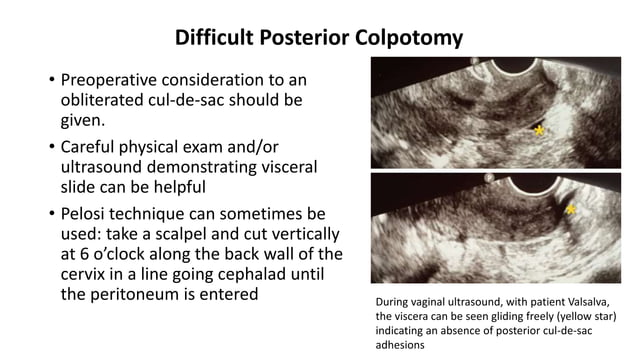 Vaginal Hysterectomy Anterior and Posterior Colpotomies | PPT