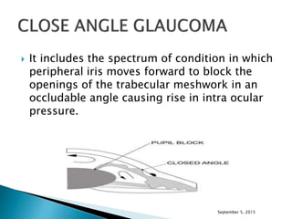 Colsed angle glaucoma | PPTX
