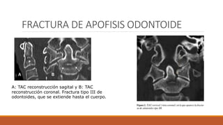 Columna cervicales | PPTX
