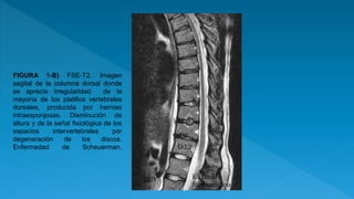 Columna Vertebral RX | PPTX