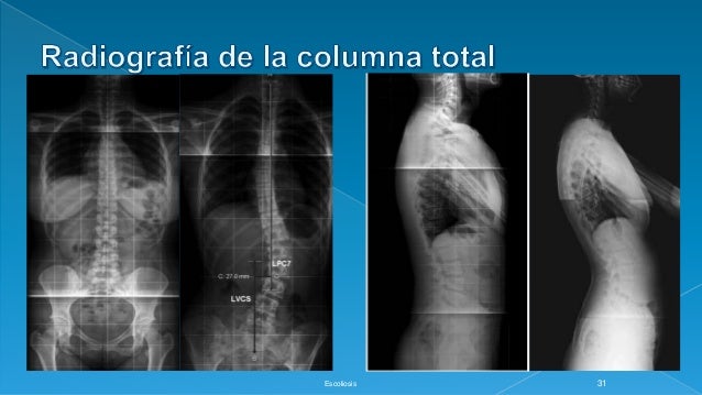 Columna Vertebral RX