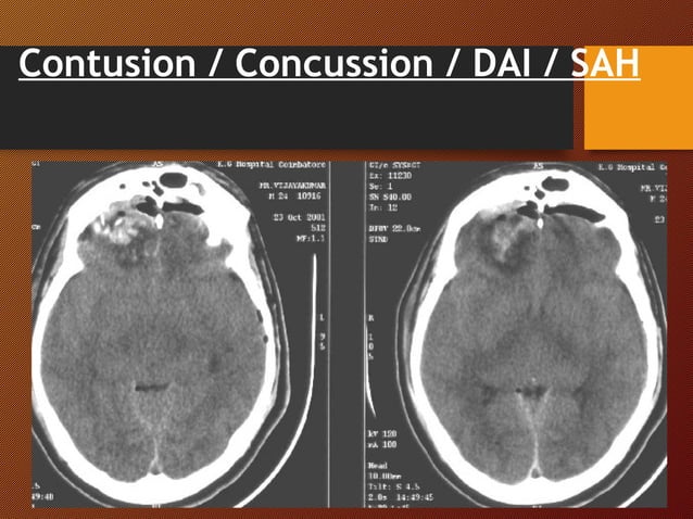 COMA.ppt unconscious patient. By Mansoor ahmed khan . | PPT