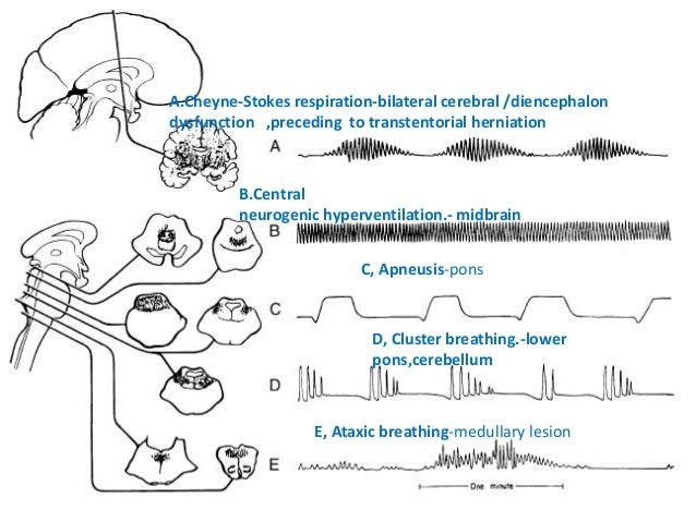 Ataxic Breathing 14 Warning Signs And Symptoms Of Brain Tumor