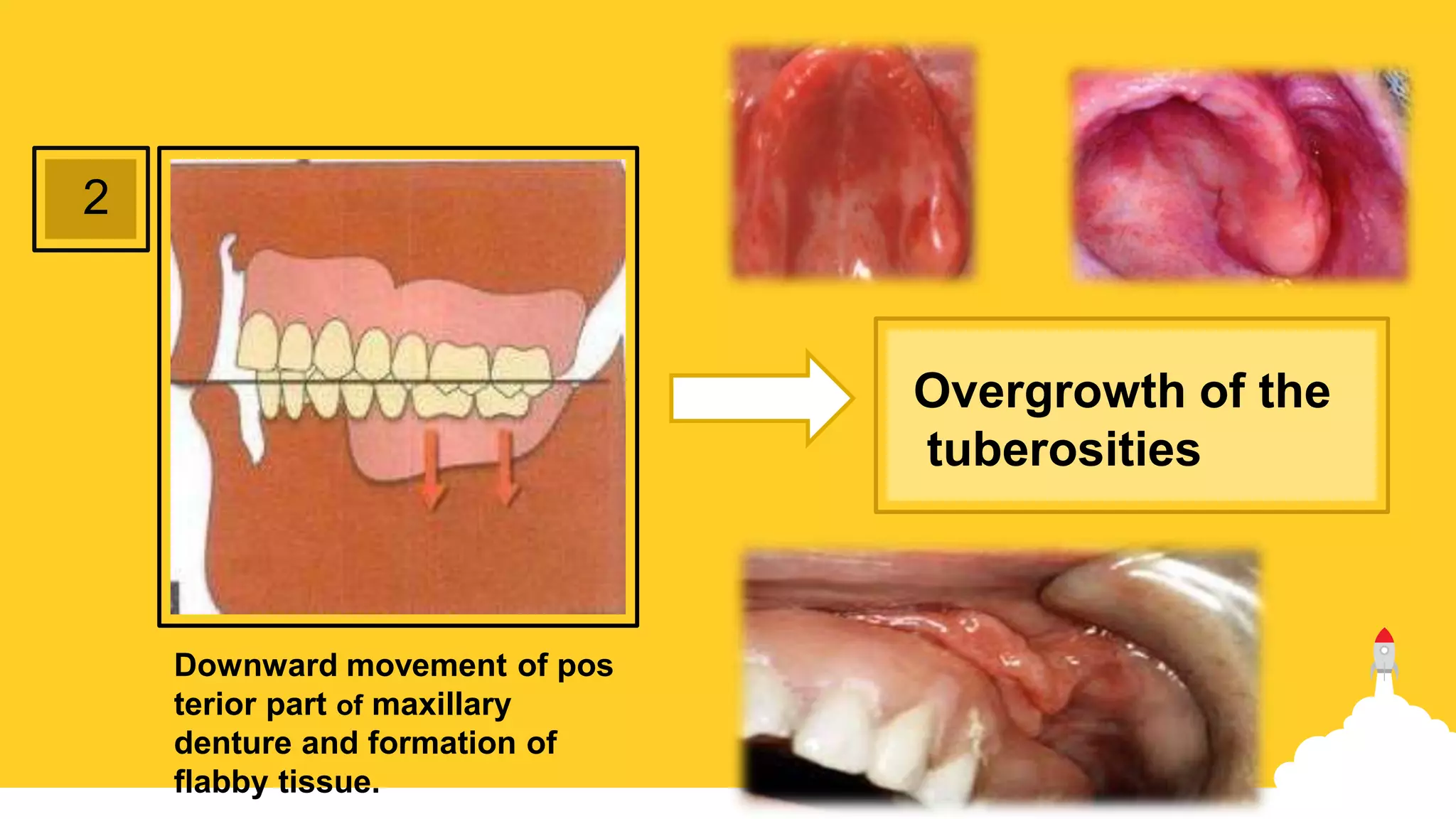 Combination syndrome | PPTX
