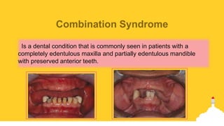 Combination syndrome | PPTX
