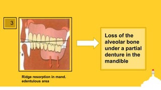 Combination syndrome | PPTX