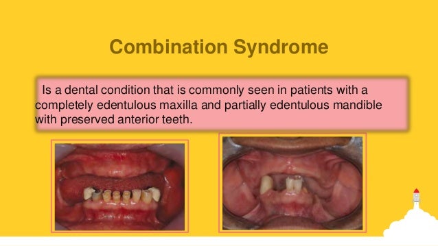 Combination syndrome