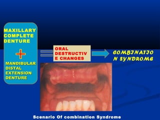 Combination syndrome revised | PPT