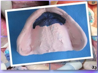 Combination syndrome revisited | PPTX