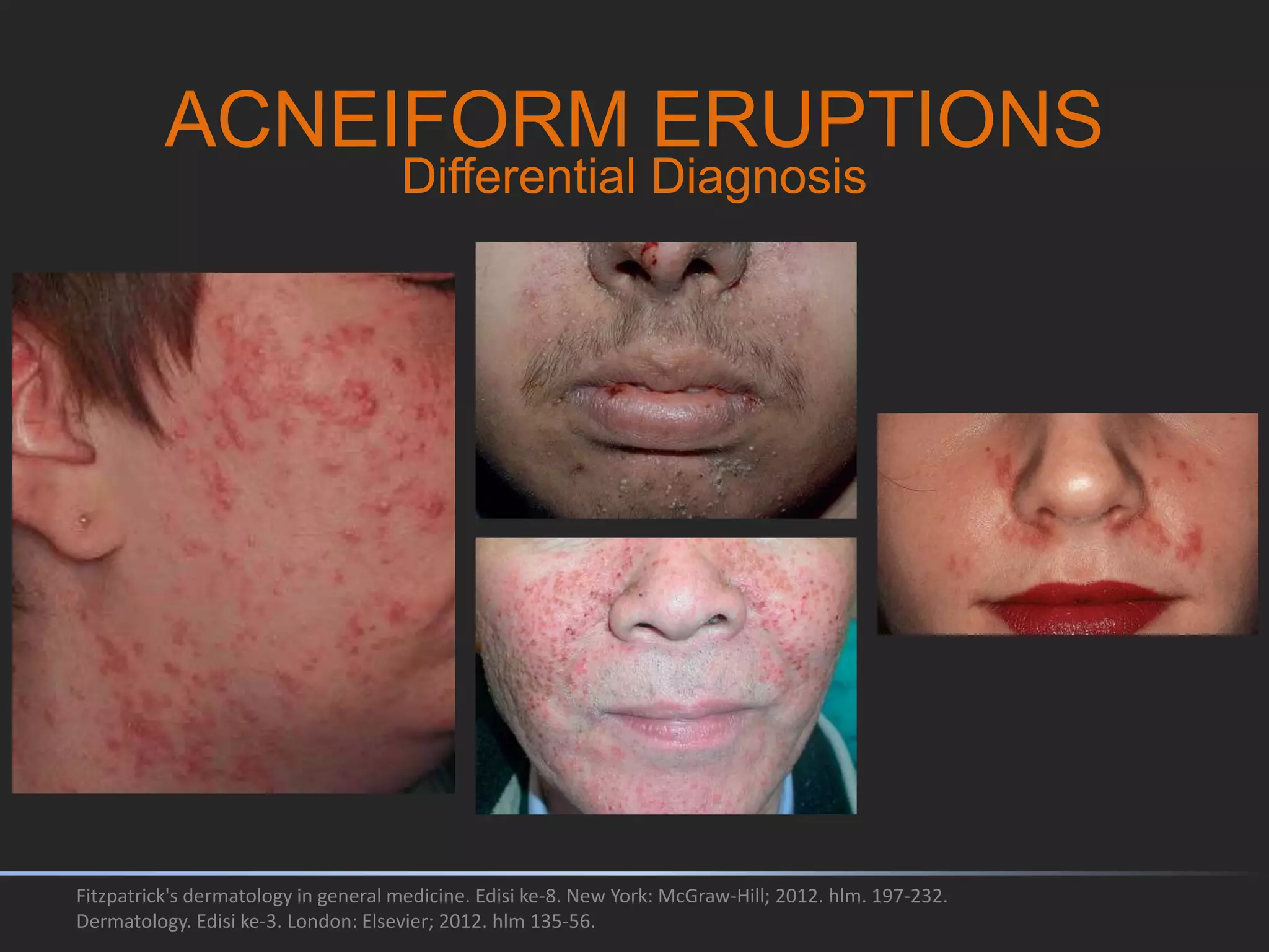 Combination therapy for recurrent acne | PPTX