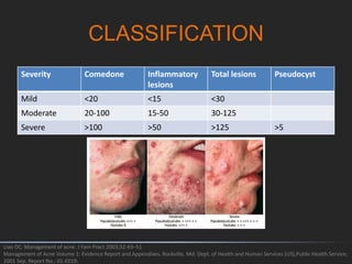 Combination therapy for recurrent acne | PPTX