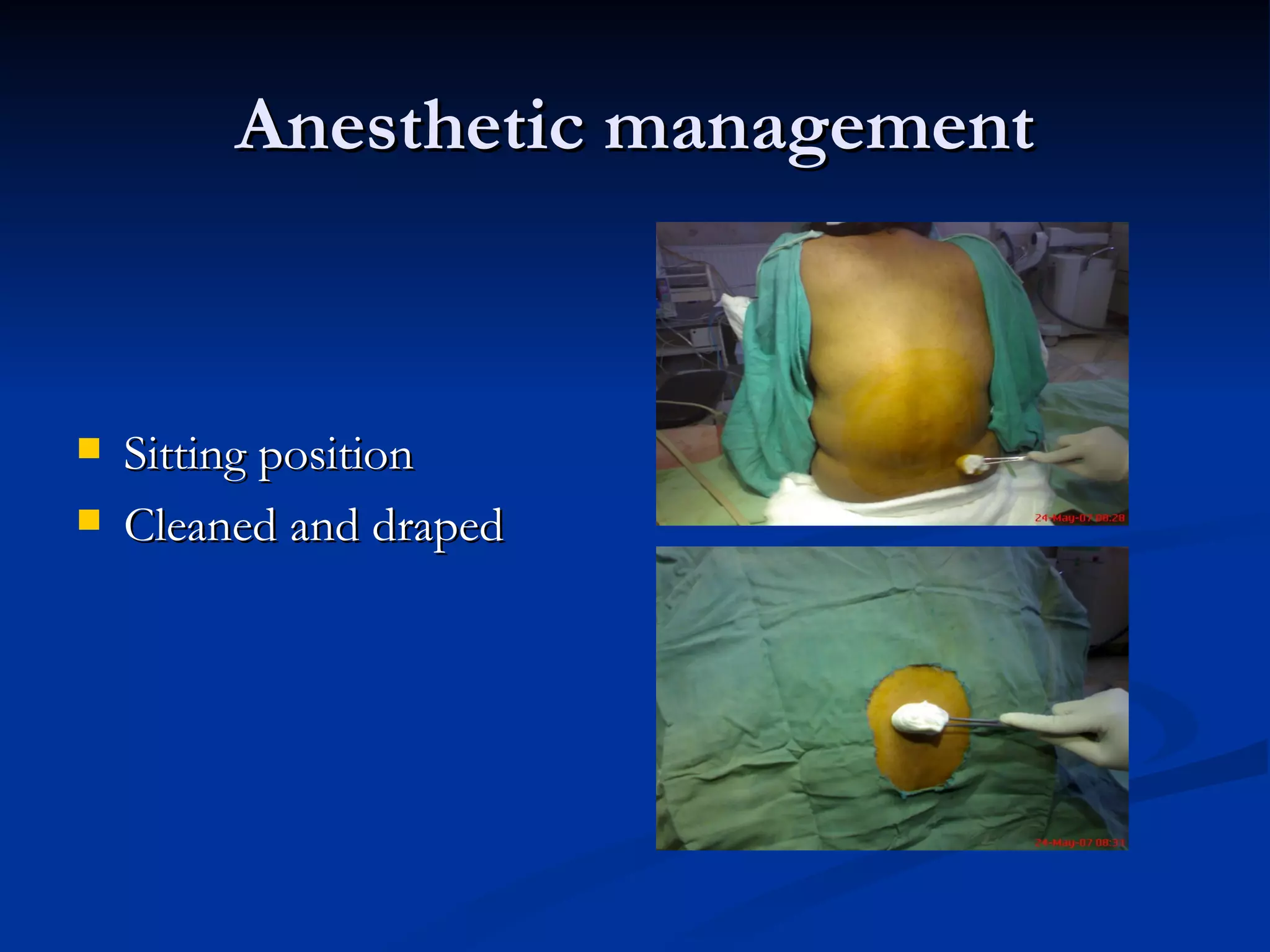 Combined Spinal Epidural Anesthesia | PPT
