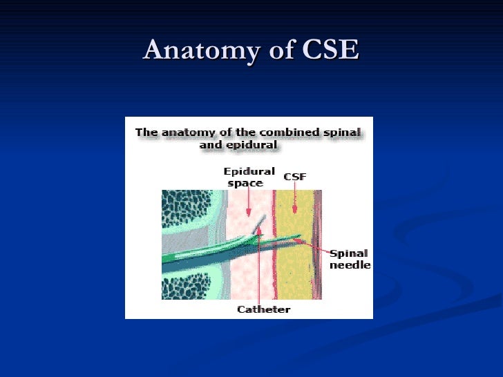 Combined Spinal Epidural Anesthesia