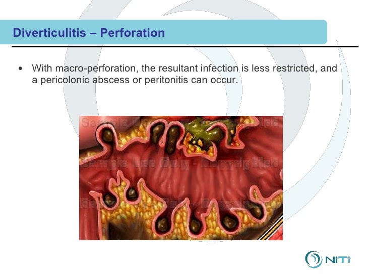 Diverticulitis Abscess