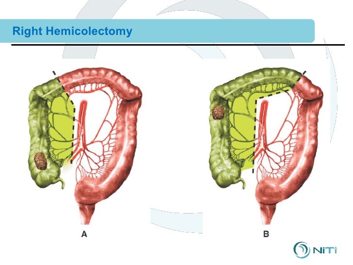 Right Hemicolectomy Steps Hemicolectomy Reviews YQTI Right Hemicolectomy Steps Hemicolectomy Reviews YQTI