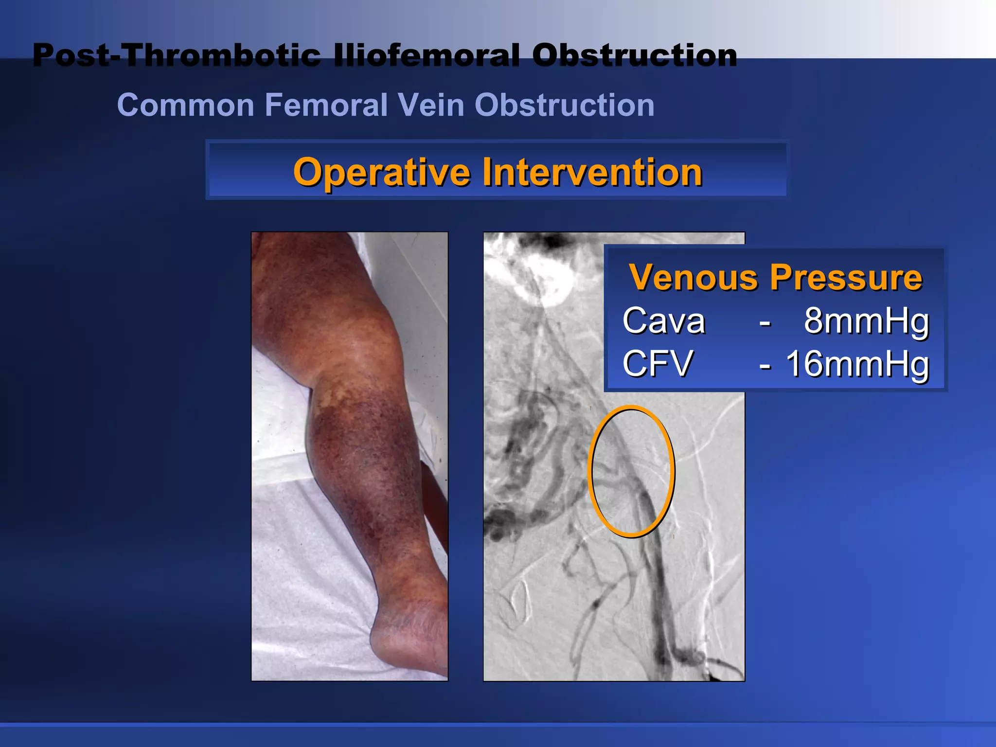 Combined common femoral endovenectomy and endoluminal recanalization ...