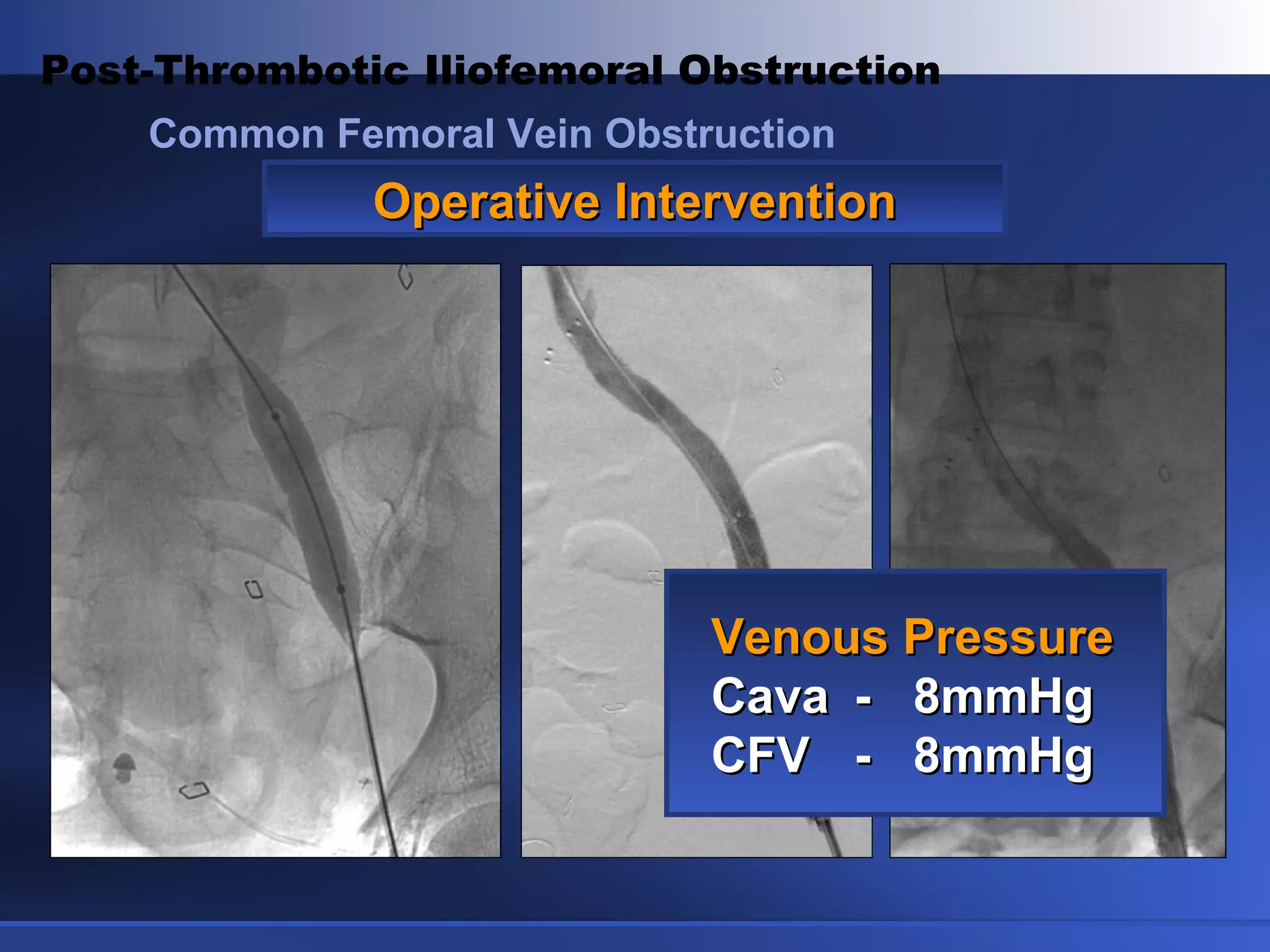 Combined common femoral endovenectomy and endoluminal recanalization ...