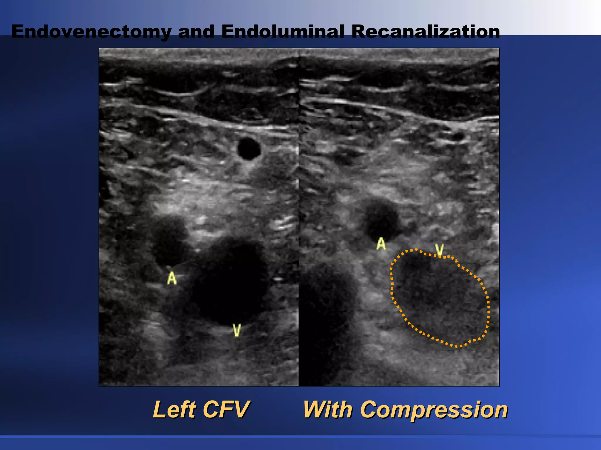 Combined common femoral endovenectomy and endoluminal recanalization ...