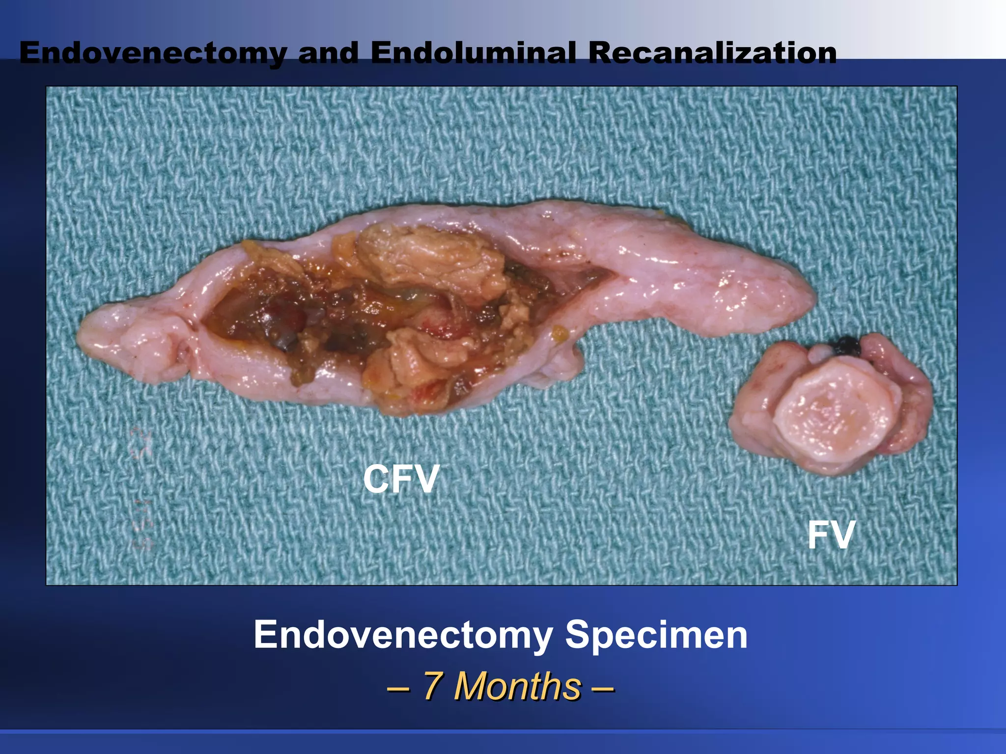 Combined common femoral endovenectomy and endoluminal recanalization ...
