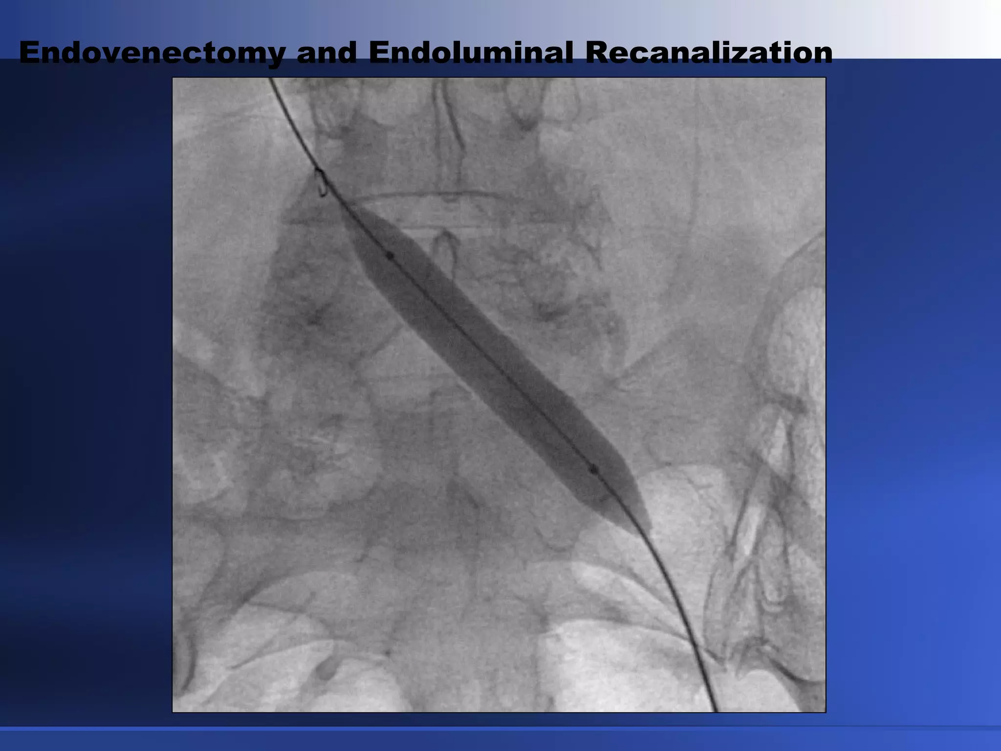 Combined common femoral endovenectomy and endoluminal recanalization ...