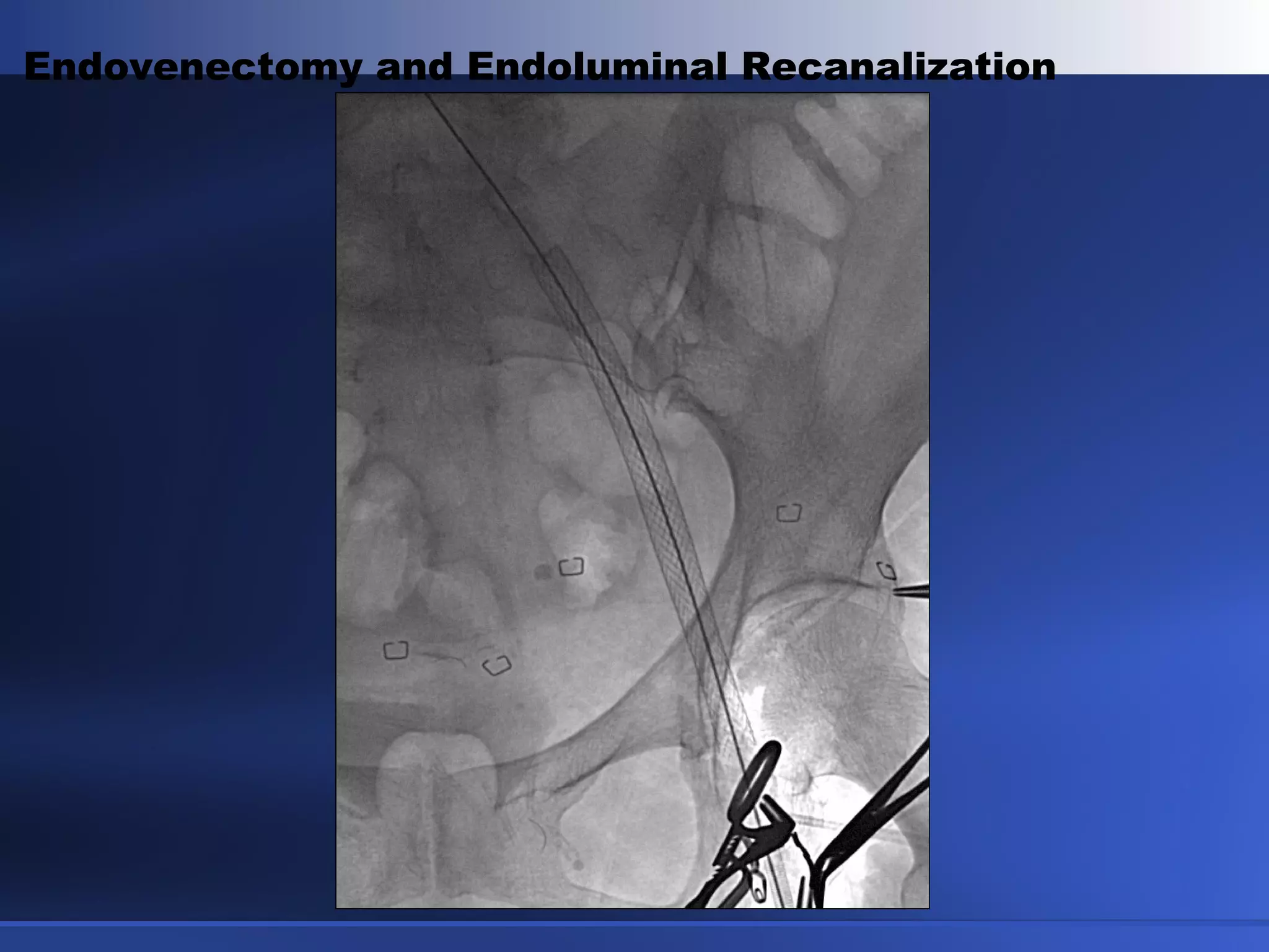 Combined common femoral endovenectomy and endoluminal recanalization ...