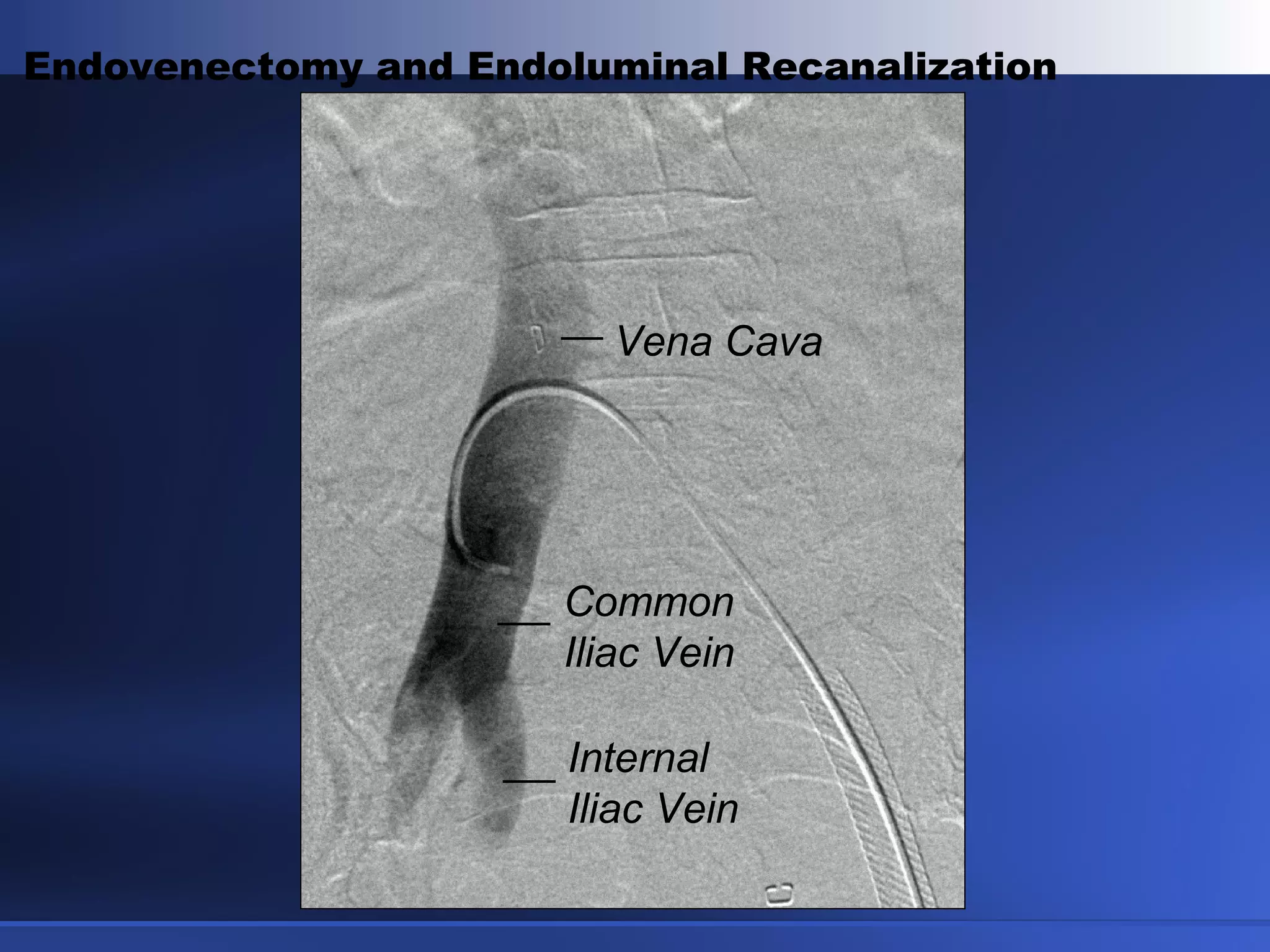 Combined common femoral endovenectomy and endoluminal recanalization for chronic post thrombotic ...