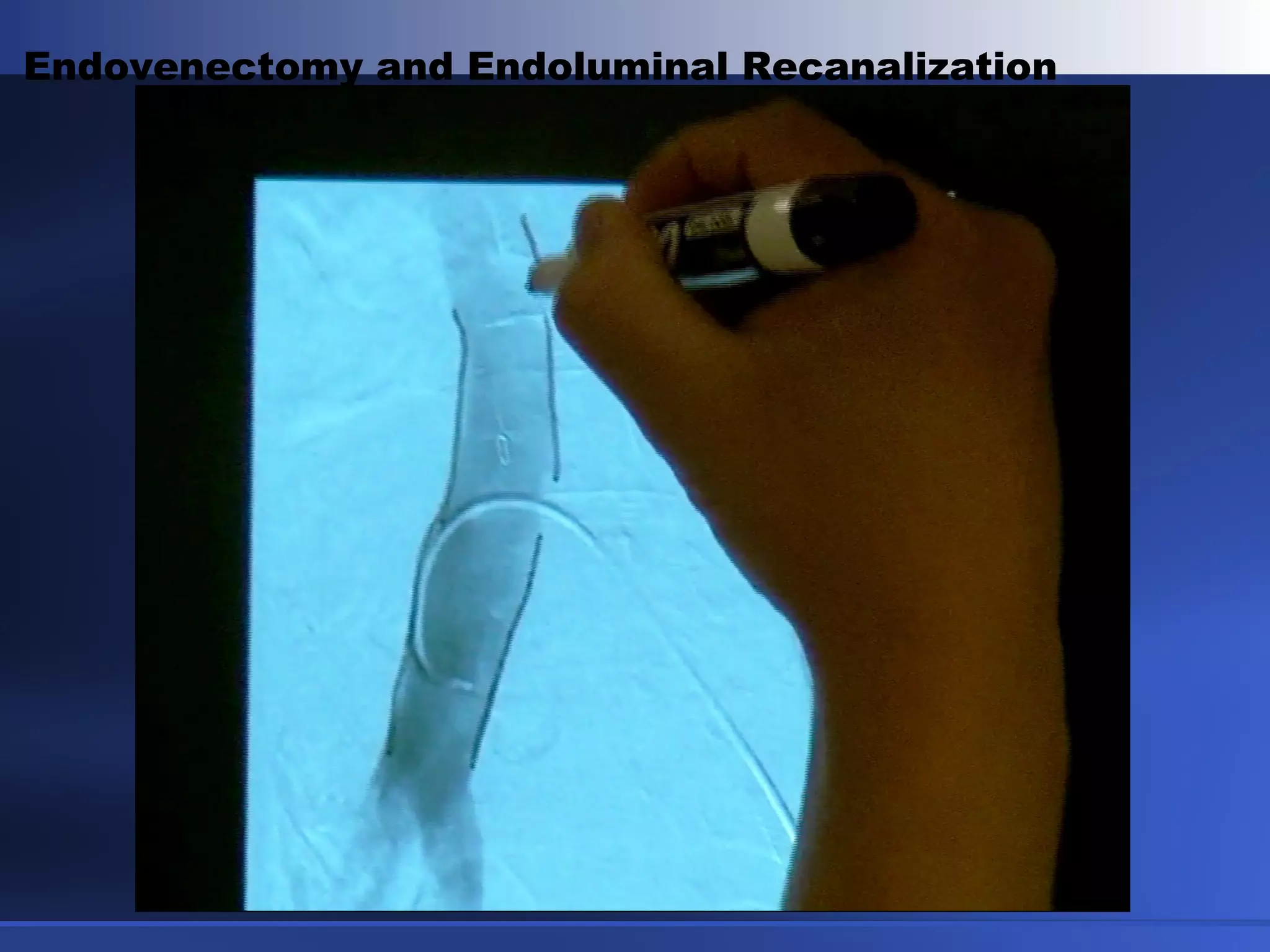Combined common femoral endovenectomy and endoluminal recanalization ...