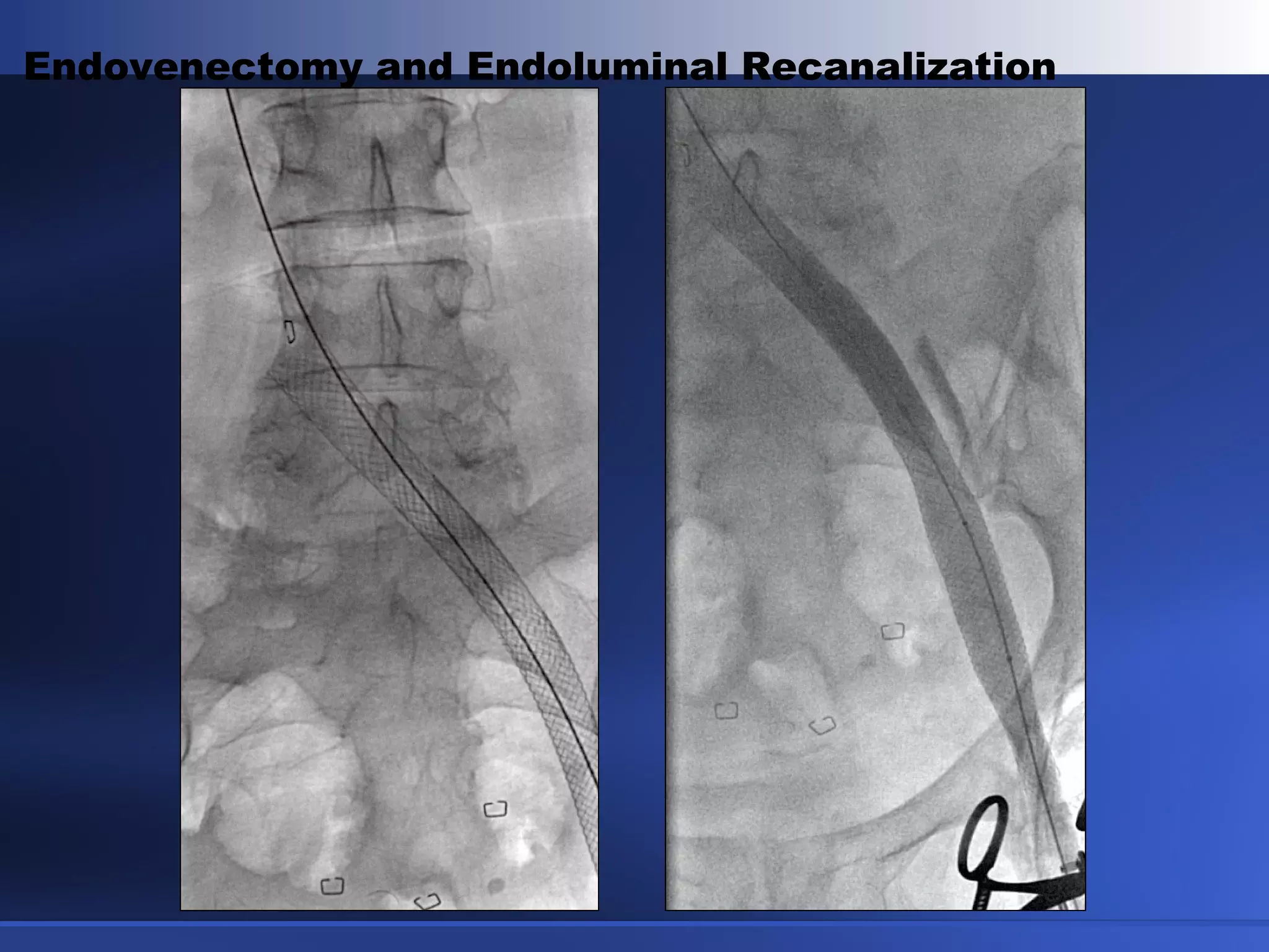 Combined common femoral endovenectomy and endoluminal recanalization ...