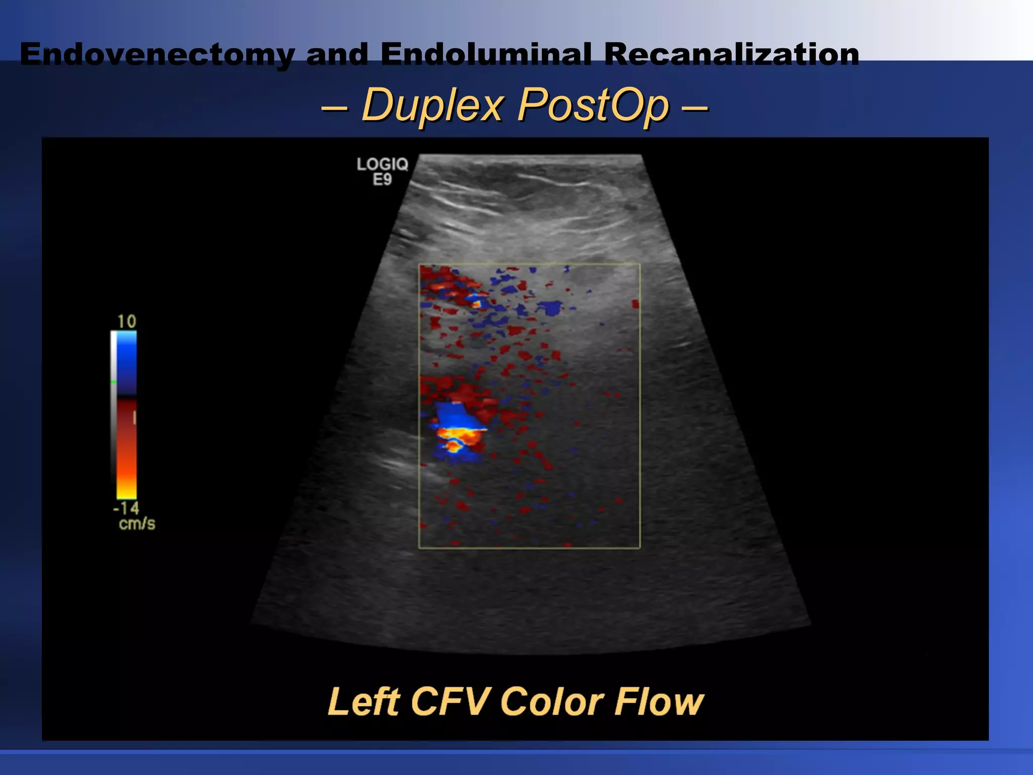 Combined common femoral endovenectomy and endoluminal recanalization ...