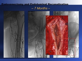 Combined common femoral endovenectomy and endoluminal recanalization ...