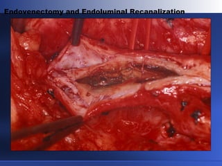 Combined common femoral endovenectomy and endoluminal recanalization ...