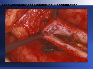 Combined common femoral endovenectomy and endoluminal recanalization ...