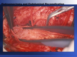 Combined common femoral endovenectomy and endoluminal recanalization ...