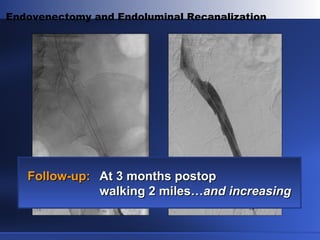 Combined common femoral endovenectomy and endoluminal recanalization ...