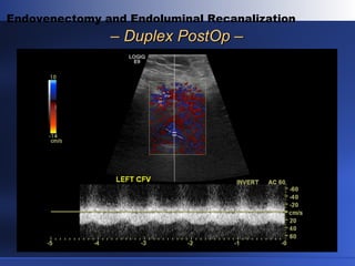 Combined common femoral endovenectomy and endoluminal recanalization ...