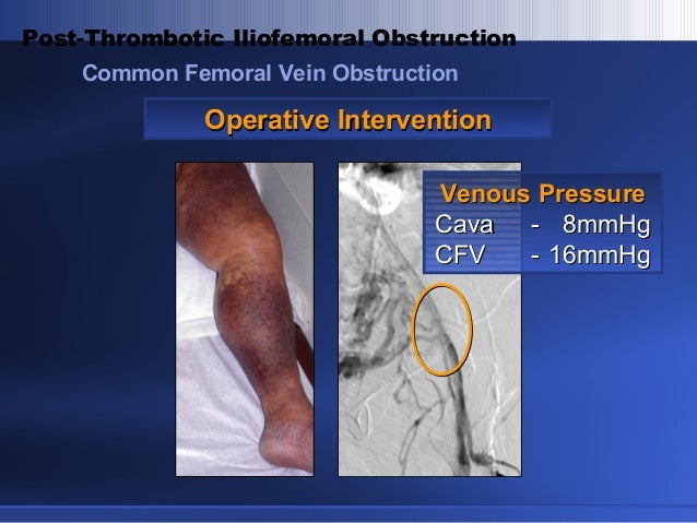 Combined common femoral endovenectomy and endoluminal recanalization