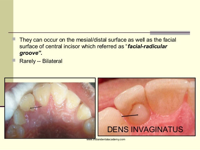 Combined endodontic periodontic treatment of a palatal groove/ dental…