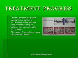Combined fixed functional class ii treatment | PPT