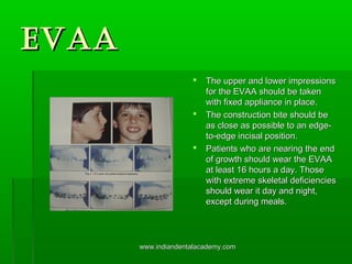 Combined fixed functional class ii treatment | PPT