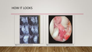 Combined medial and lateral bucket handle meniscus tears_023024.pptx