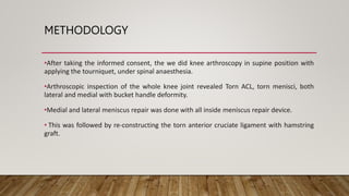 Combined medial and lateral bucket handle meniscus tears_023024.pptx