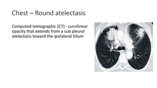 COMET TAIL SIGN: The comet tail sign is a finding that can be seen on ...