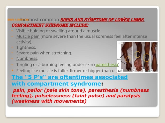 Compartment syndrome, meaning , types, causes , nursing management ...